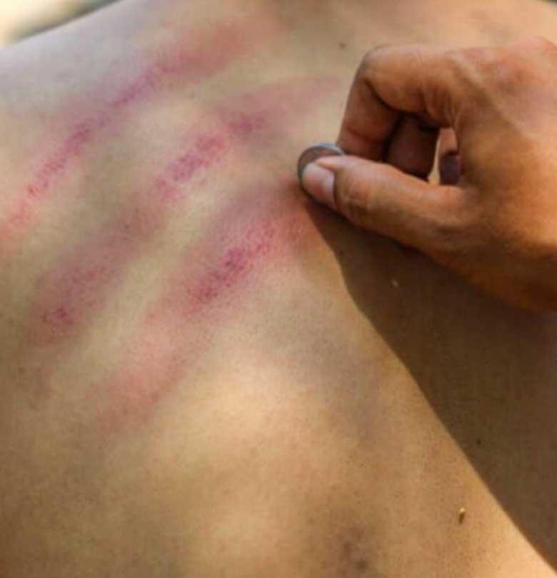 Berbagai Jenis Kerokan Saat Demam Dari Berbagai Belahan Dunia ...